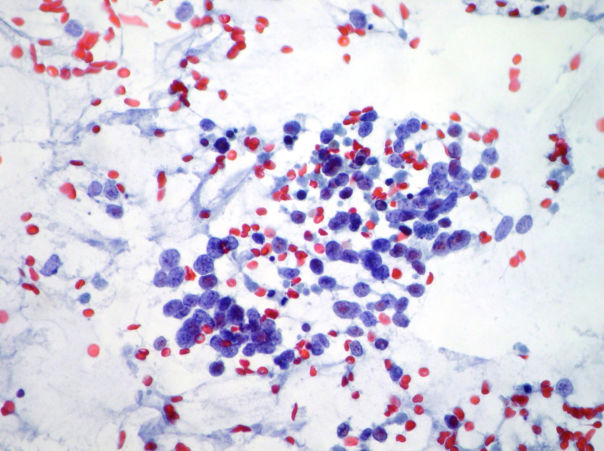 Καρκίνος του πνεύμονα: Πώς φαίνεται στις ακτινογραφίες - Φωτογραφίες ...